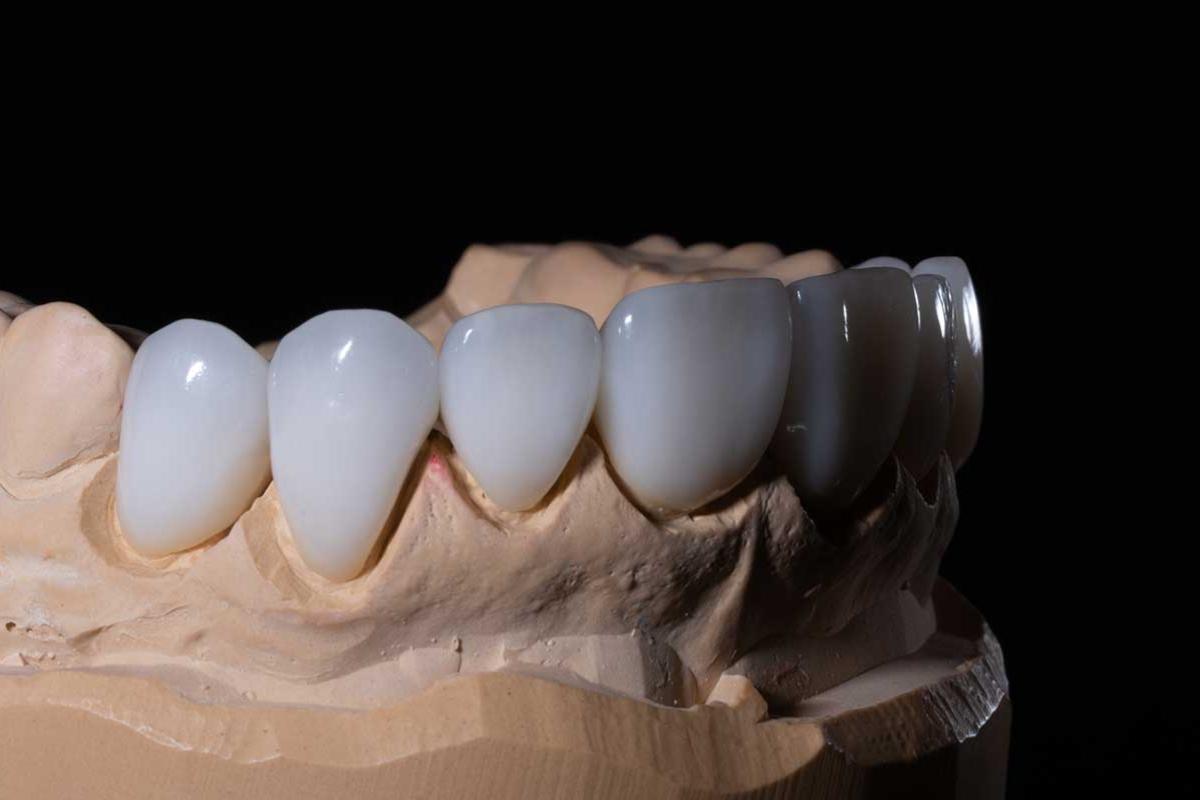 5 Benefits Of Dental Veneers Dental Veneers In Texas